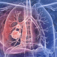 ACI | Lung Cancer Screening & Continuum of Care - ACI